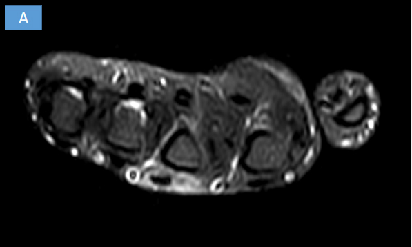 A 52-year-old male presented with history of injury to the right hand 1 ...