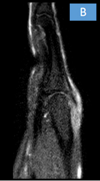 A 52-year-old male presented with history of injury to the right hand 1 ...
