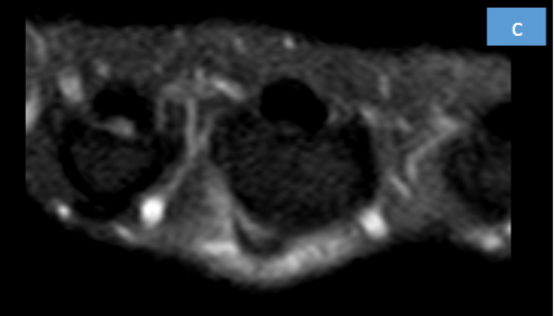 A 52-year-old male presented with history of injury to the right hand 1 ...